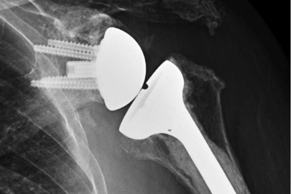 Engineered compound shows promise in preventing bone loss in space