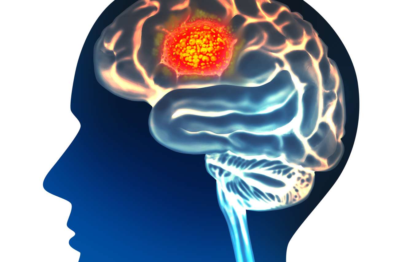 Tumor-secreted protein may hold the key to better treatments for deadly ...